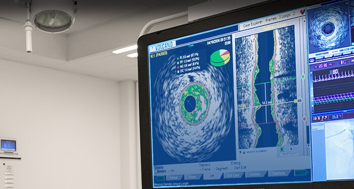 冠動脈画像誘導治療装置 | Philips ヘルスケア