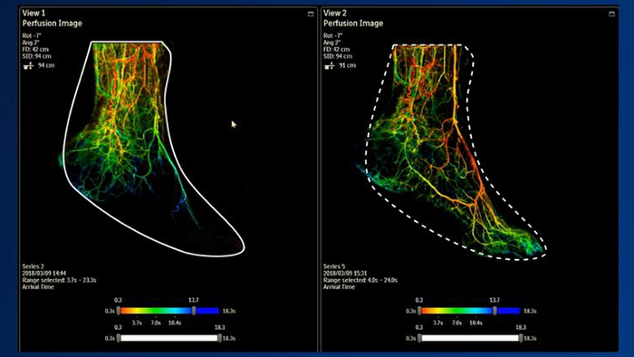Peripheral arterial intervention | フィリップスヘルスケア